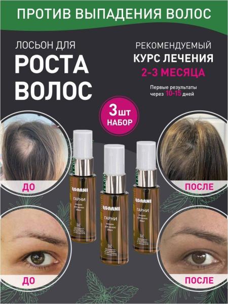 Mintop 10 - лосьон для волос на основе миноксидила : общая информация и ...